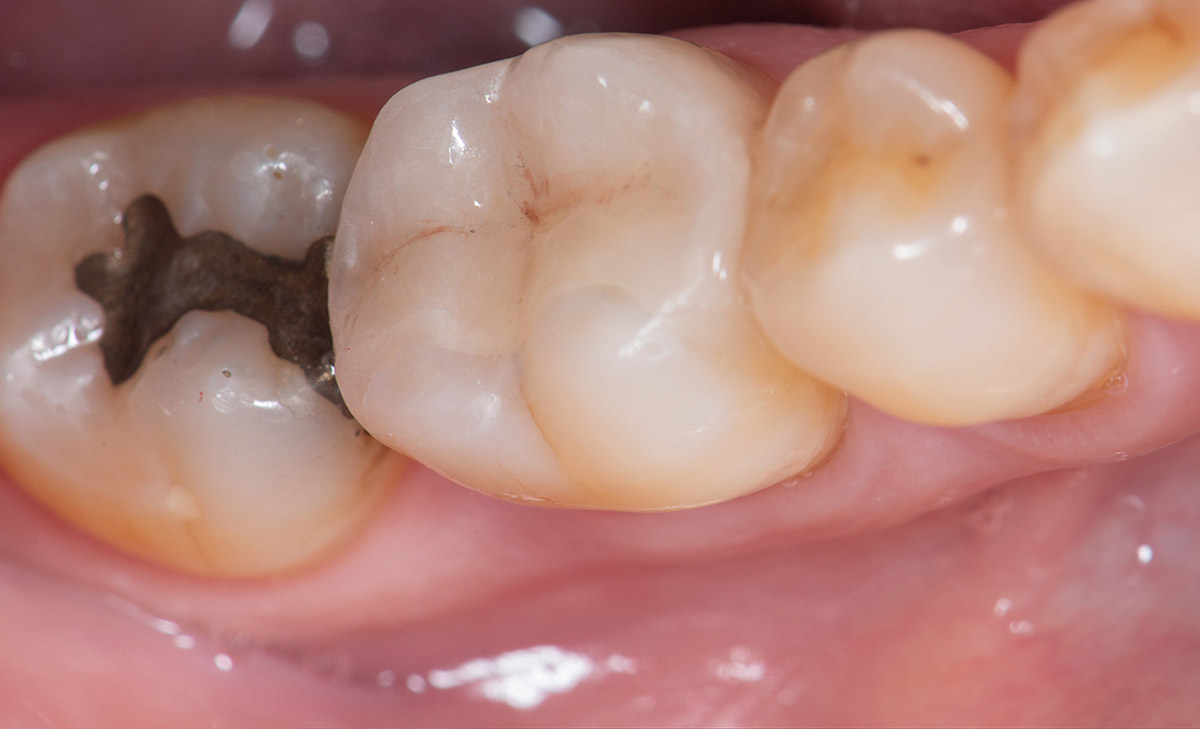 Porcelain Inlays & Onlays - MVP Dental
