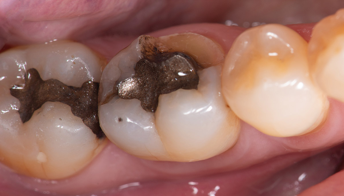 Porcelain Inlays & Onlays - MVP Dental